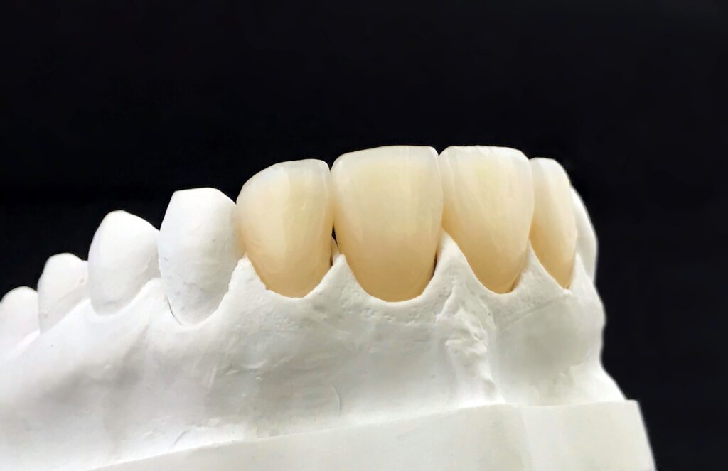 The Rise of Zirconia in Dentistry: Strength, Aesthetics, and Innovation