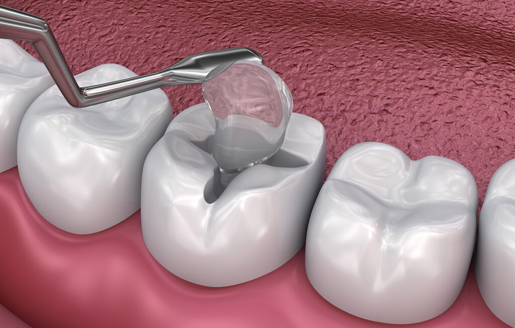 IRM in Dentistry: Uses, Benefits, and Why It’s Still Relevant Today