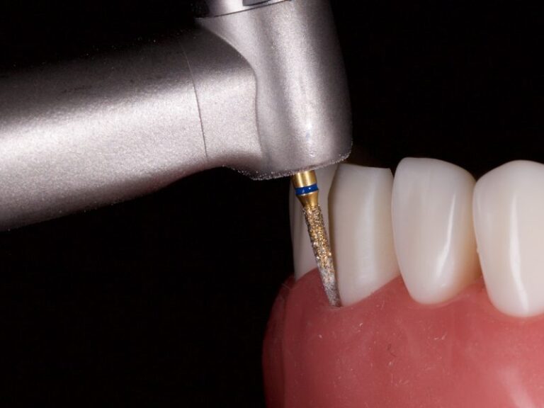 VertiPrep and BOPT: Cutting-Edge Crown Techniques for Better Dental ...